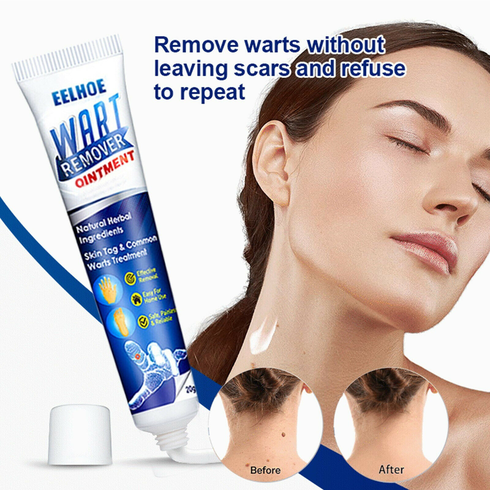 Wart Removal Treatment Cream Plantar Flat Filiform Periungual Common ...